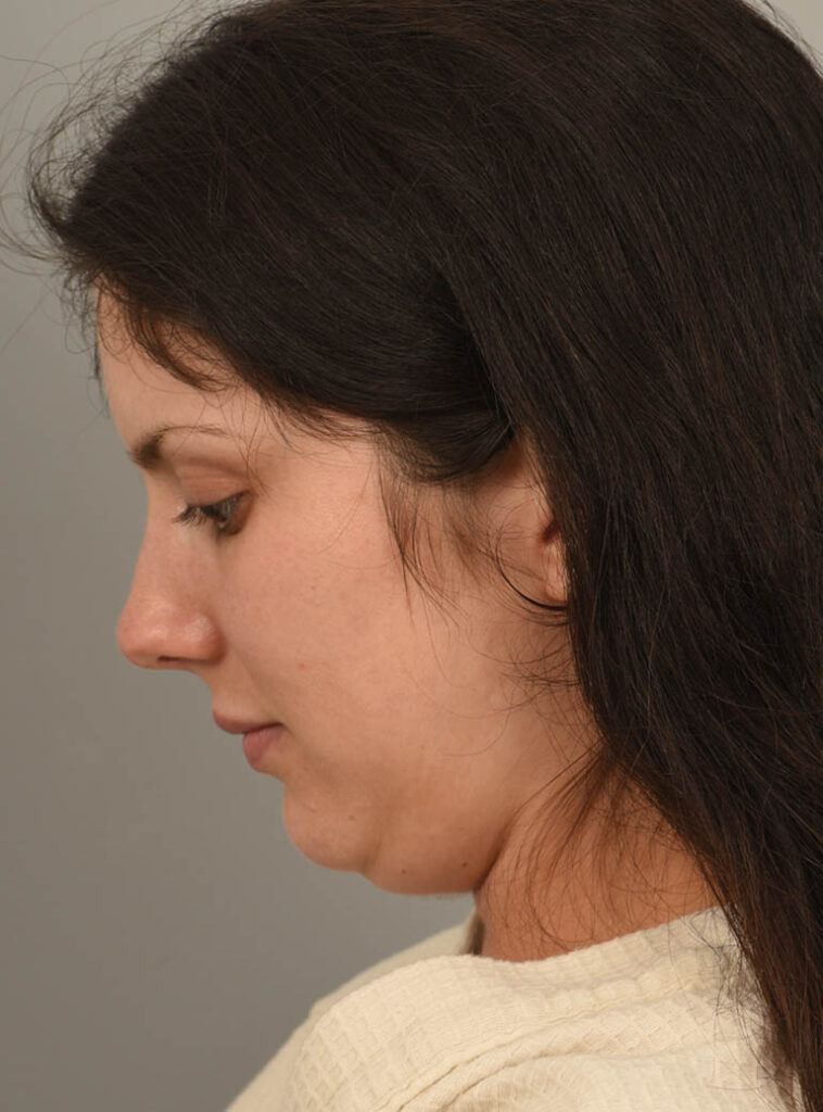 Deep Neck Contouring In Orange County, CA | Neck Lift San Clemente